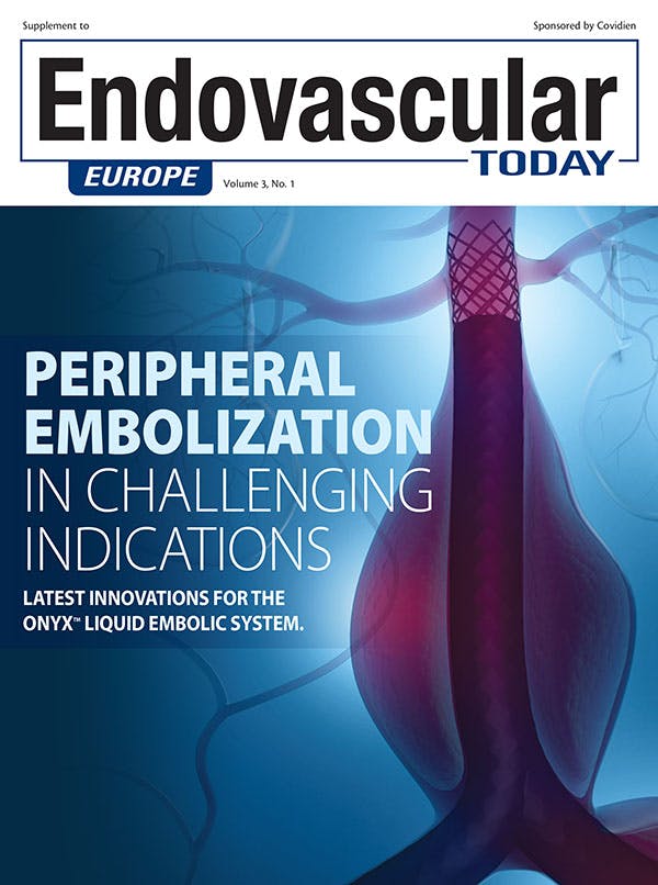 Ethylene-Vinyl Alcohol Copolymer (Onyx™ Liquid Embolic System) to Seal ...